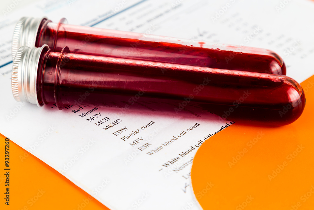 Blood sample in test tubes with health analysis screening report Stock ...