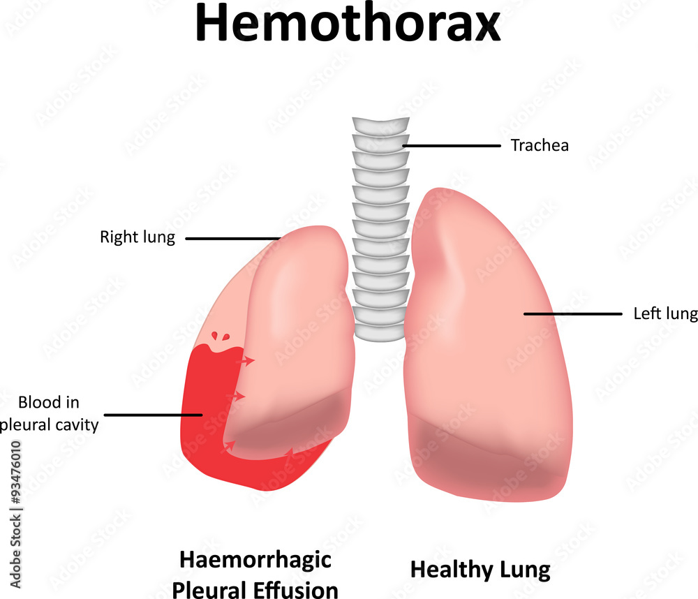 Hemothorax Illustration vector de Stock | Adobe Stock