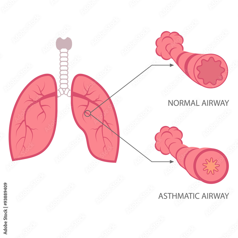 vector asthma illustration, bronchial, lungs respiratory disease, Stock ...