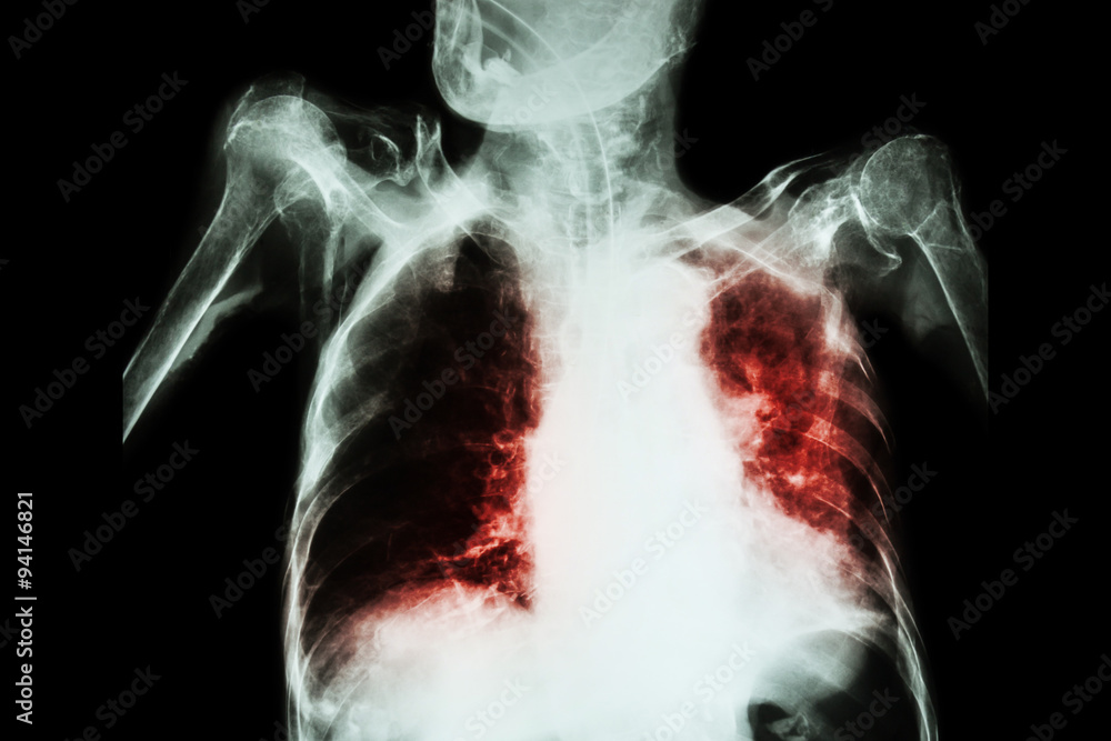 Pulmonary Tuberculosis with acute respiratory failure ( Film chest x ...