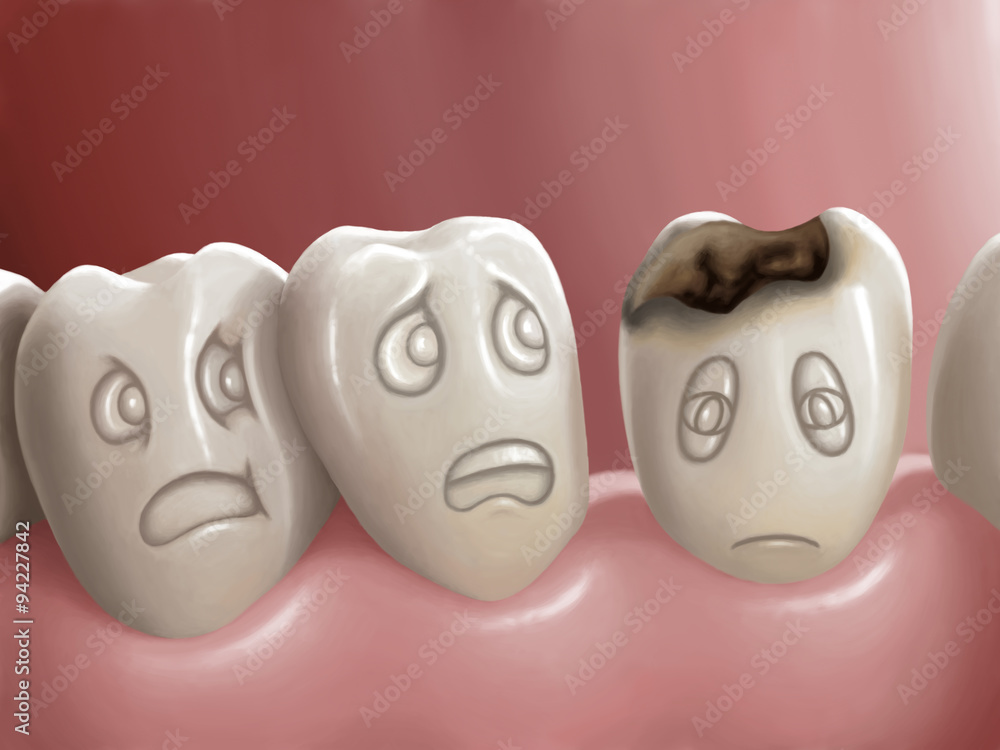Dental caries Stock Illustration | Adobe Stock