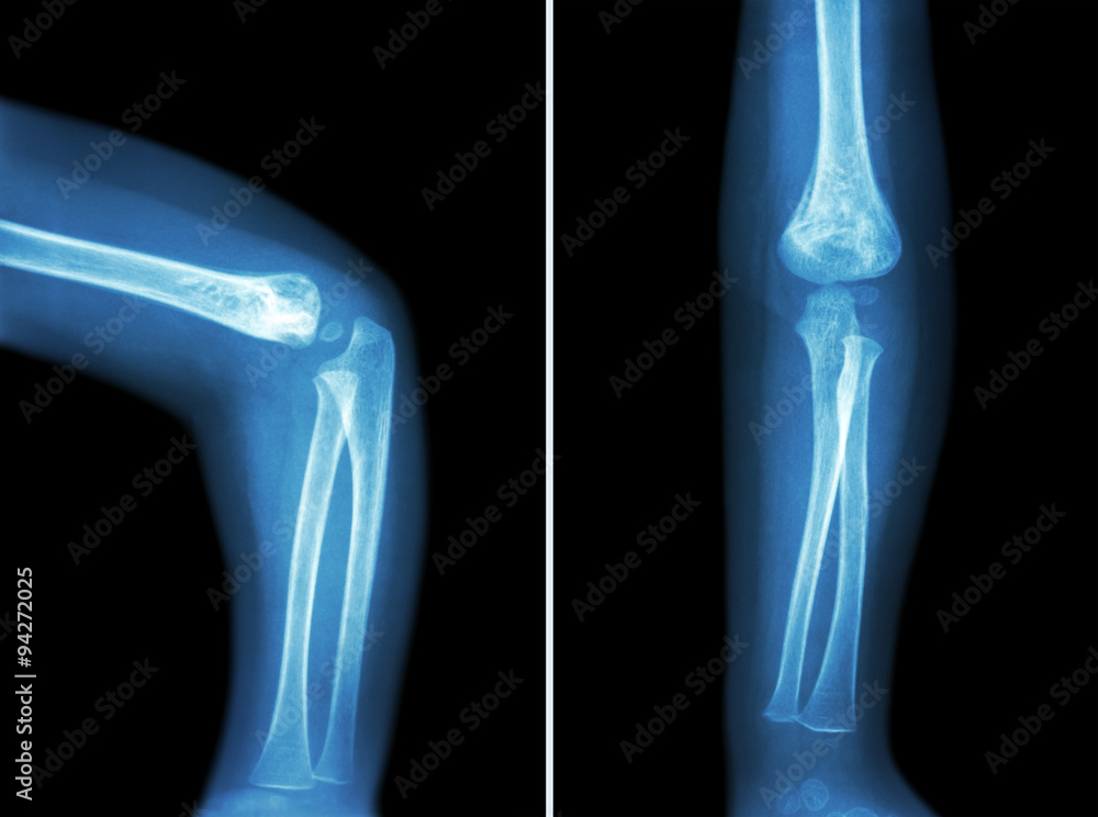 Film x-ray of child 's elbow ( normal child 's elbow ) ( Side and front ...