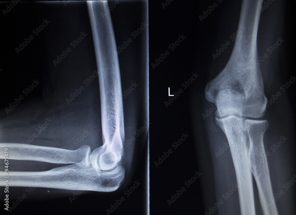 X-ray orthopedics Traumatology scan of elbow joint injury Stock Photo ...