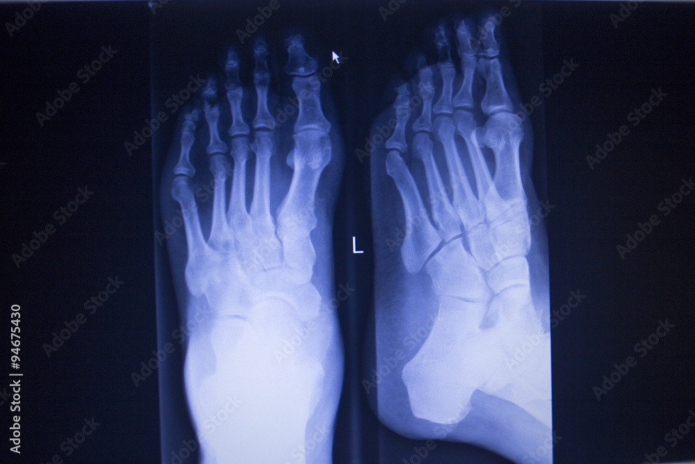 X-ray orthopedics scan of foot injury anterior posterior AP Stock Photo ...