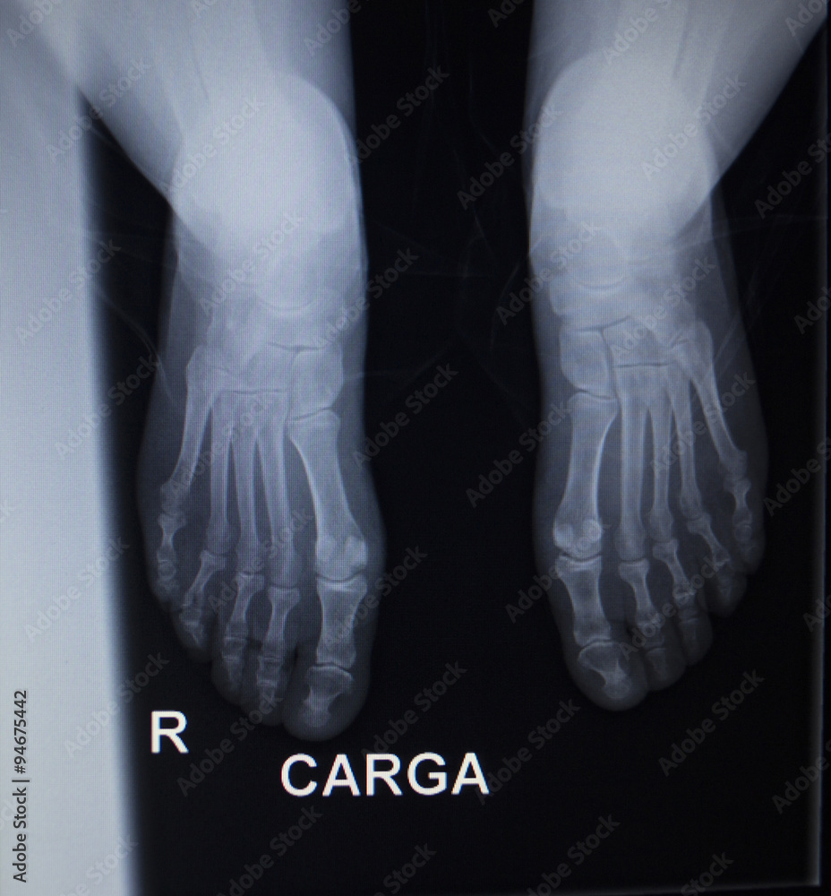 X-ray orthopedics scan of foot injury anterior posterior AP Stock Photo ...