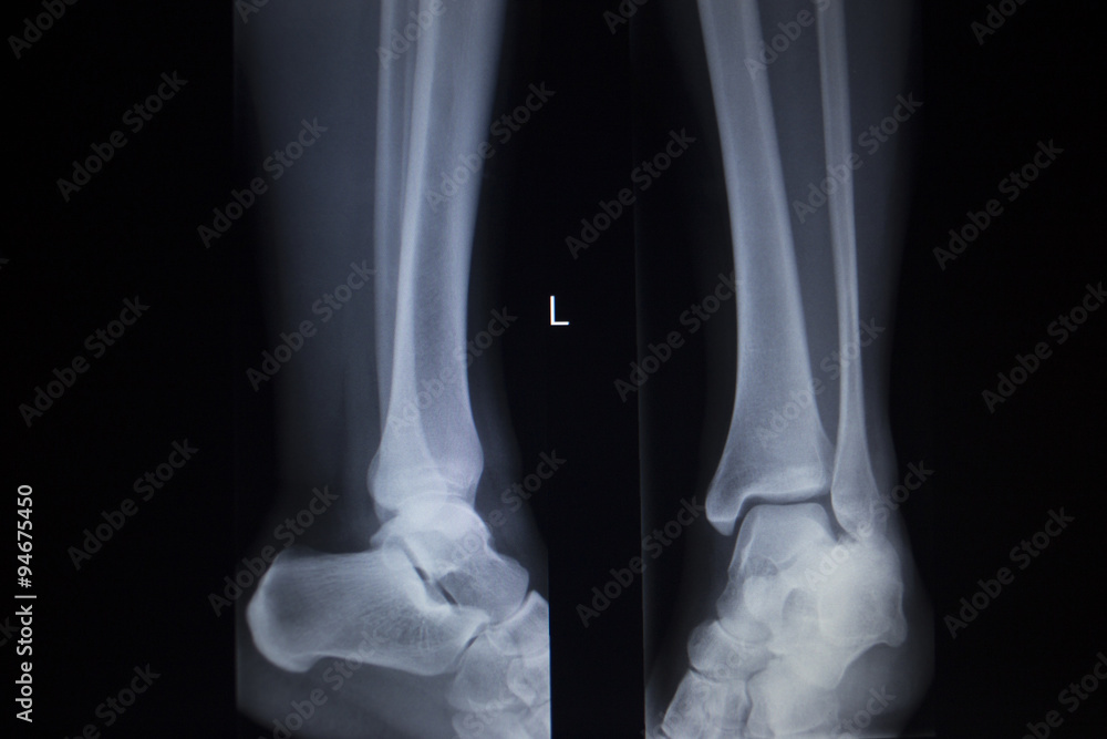 X-ray orthopedics scan of foot injury anterior posterior AP Stock Photo ...