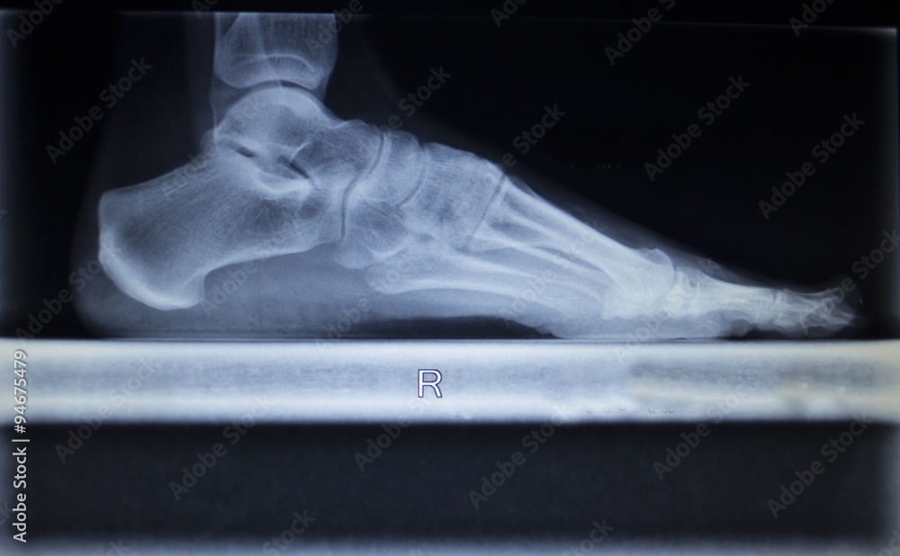 X-ray orthopedics scan of foot injury load weight bearing Stock Photo ...