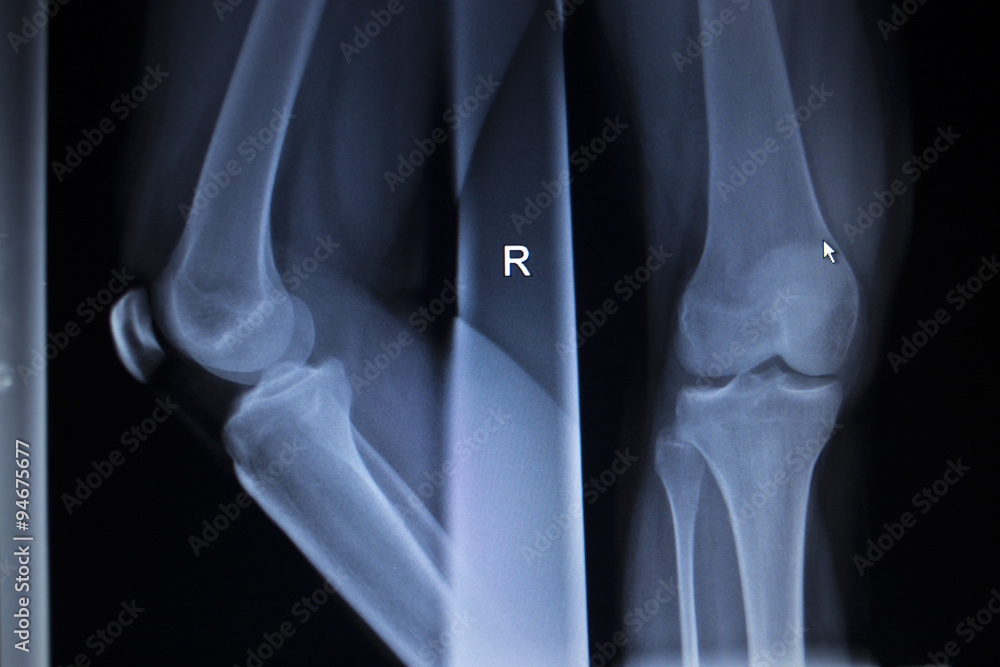 X-ray orthopedics scan of painful knee meniscus leg injury Stock Photo ...
