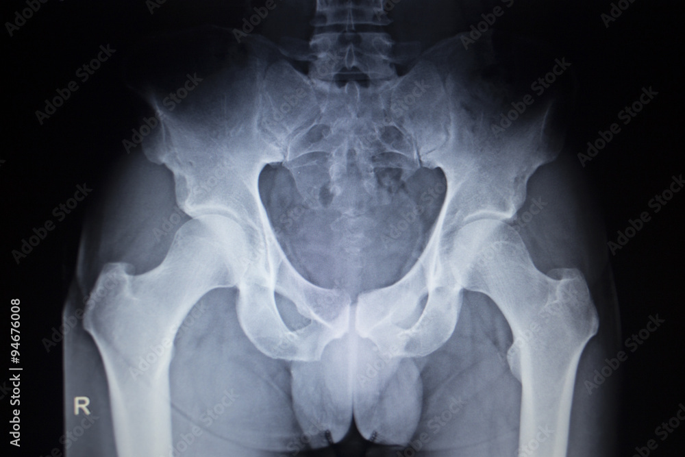 X-ray orthopedic scan image of hip joints human skeleton Stock Photo ...