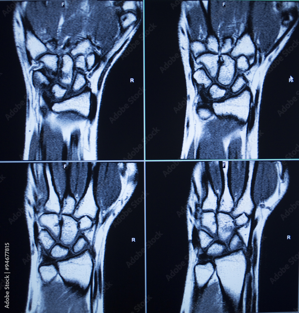 MRI scan test results wrist hand injury Stock Photo | Adobe Stock