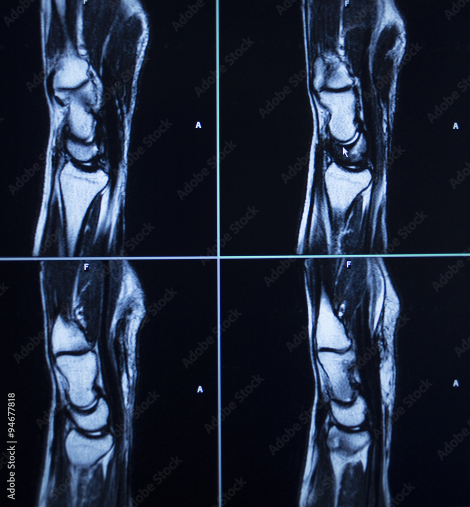 MRI scan test results wrist hand injury Stock Photo | Adobe Stock