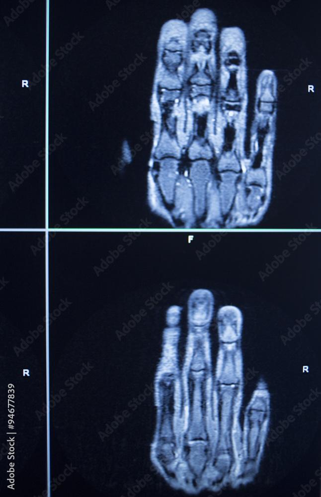 MRI scan test results hand finger injury Stock Photo | Adobe Stock