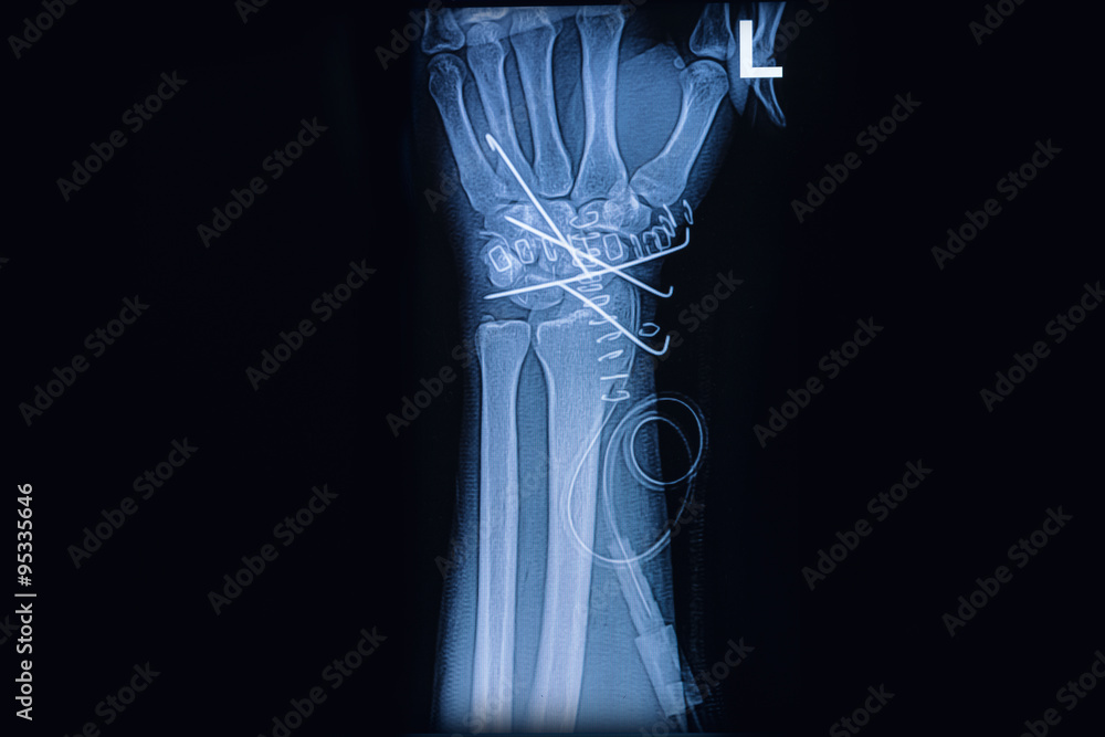 X-ray image of wrist joint, Showing radius fracture with k wire Stock ...