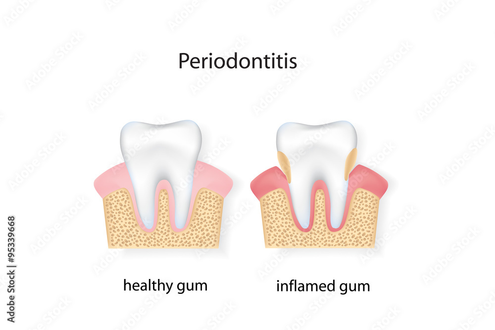 Periodontitis. Stock Illustration | Adobe Stock