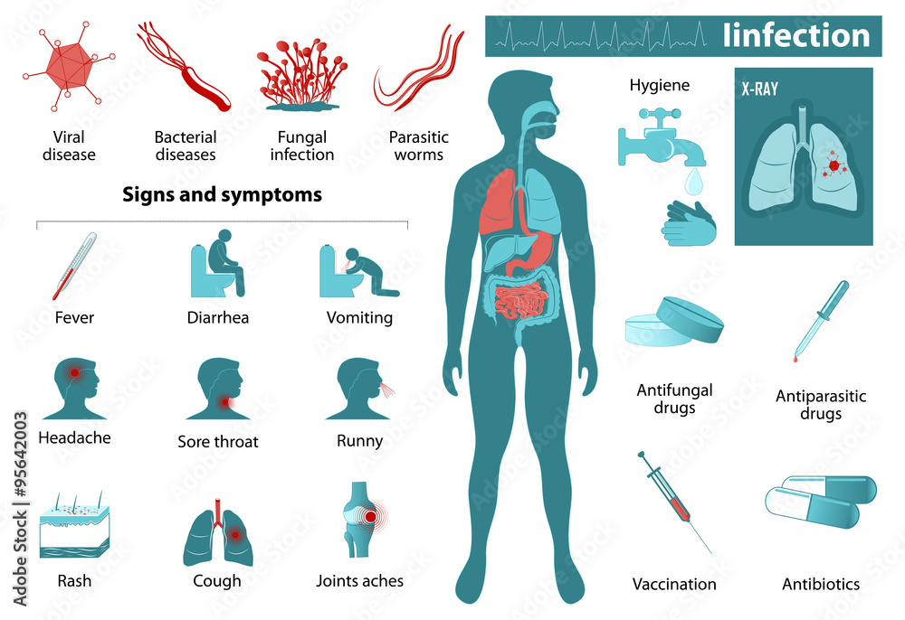 infection infographics Stock Vector | Adobe Stock