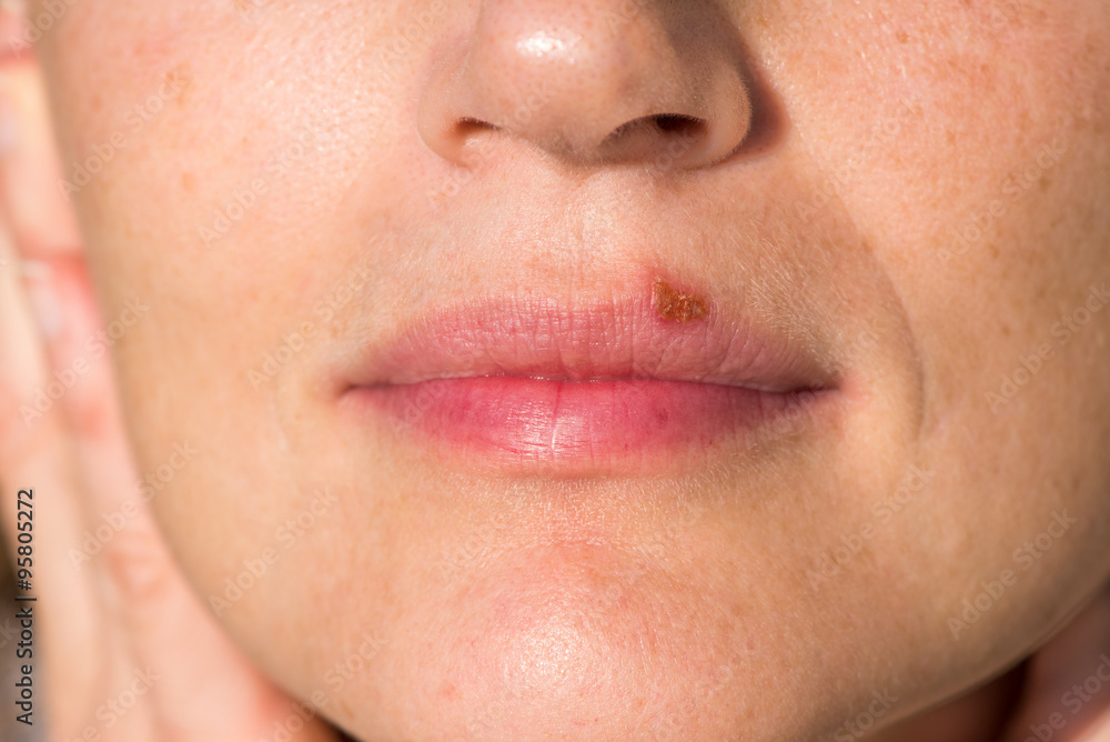 Herpes labialis: oral herpes on upper lip of a woman Stock Photo ...