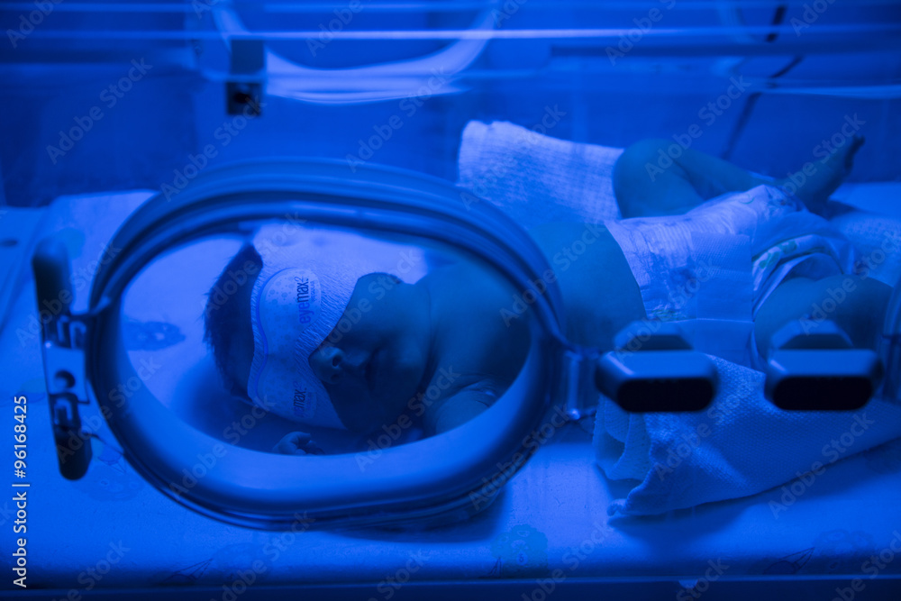 Newborn Baby having UVB phototherapy treatment for jaundice Stock Photo ...