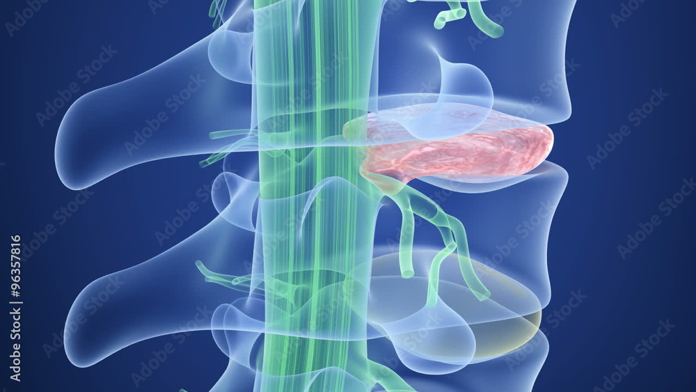 Spinal cord under pressure of bulging disc, X-Ray view. 3D illustration ...