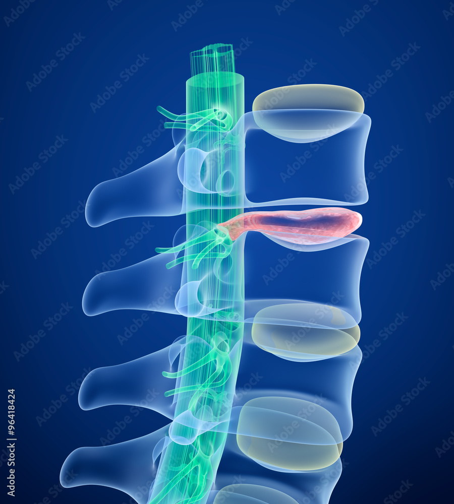 Spinal cord under pressure of bulging disc, X-Ray view. 3D illustration ...