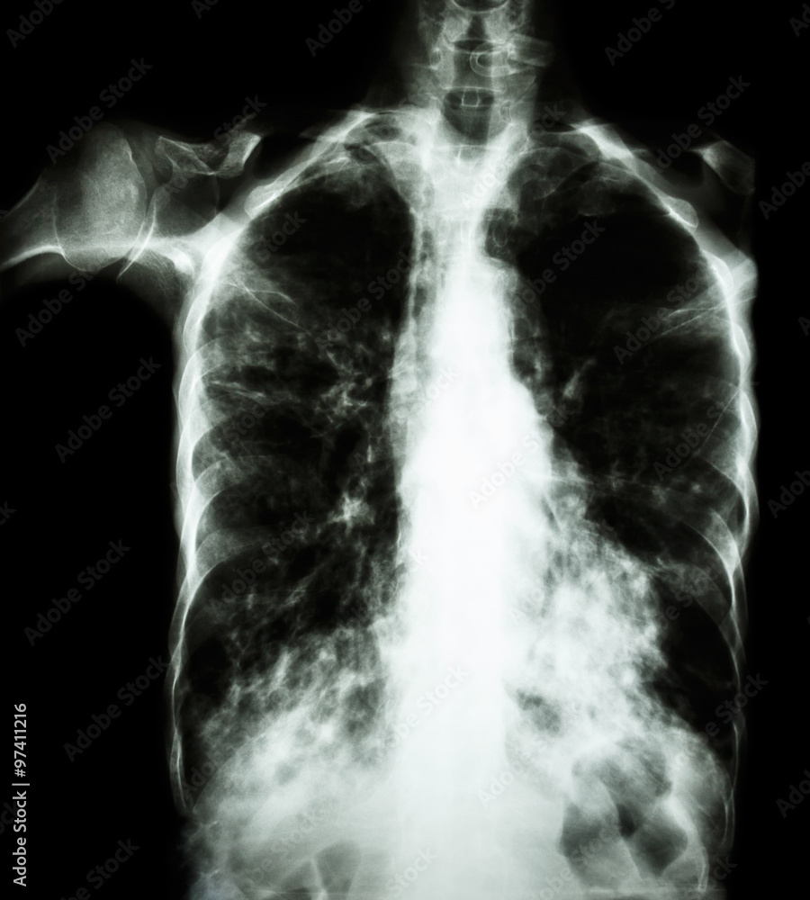 Pulmonary Tuberculosis ( film chest x-ray : interstitial infiltrate ...