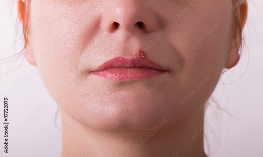 Girl lip diseased herpes. scabs on the stage of drying Stock Photo ...