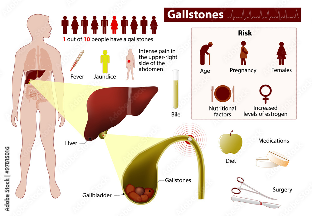 gallstones. Medical infographic Stock Vector | Adobe Stock
