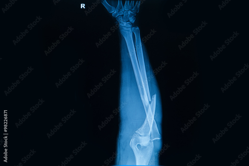 Collection of human x-rays showing fracture of radius bone Stock Photo ...