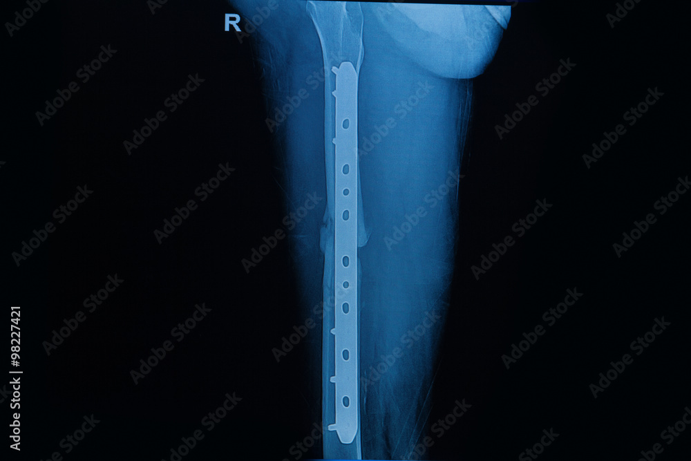 Human x-rays showing fracture of femur bone with plate and screw Stock ...