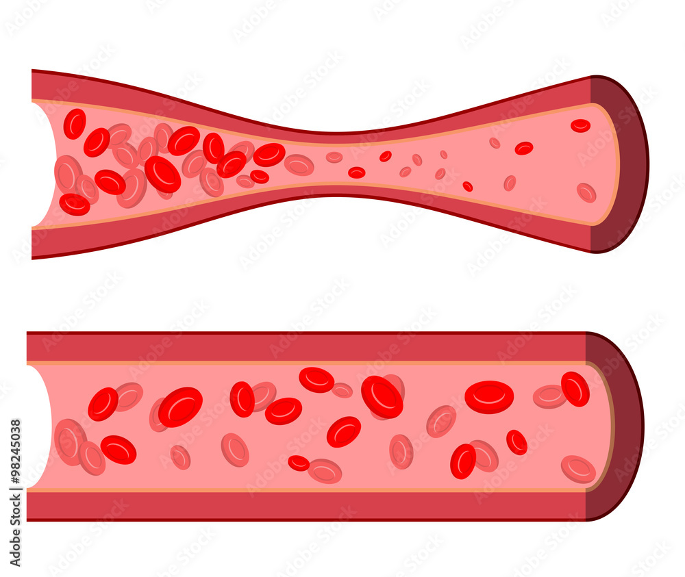 Bloody artery. Blockage of blood vessels. Sick artery with leuk Stock ...