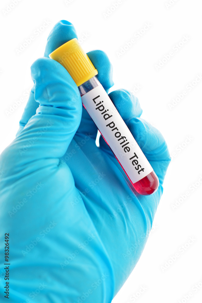 Blood sample for lipid profile test Stock Photo | Adobe Stock