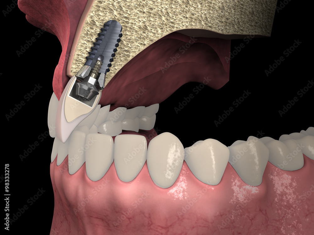 Dental anatomy - Upper incisor longitudinal section with dental implant ...