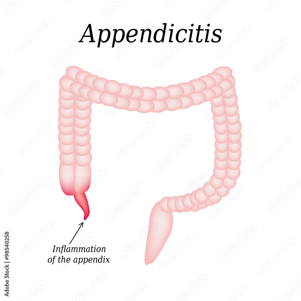 Appendicitis. Inflammation of the appendix. Colon. The illustration on ...