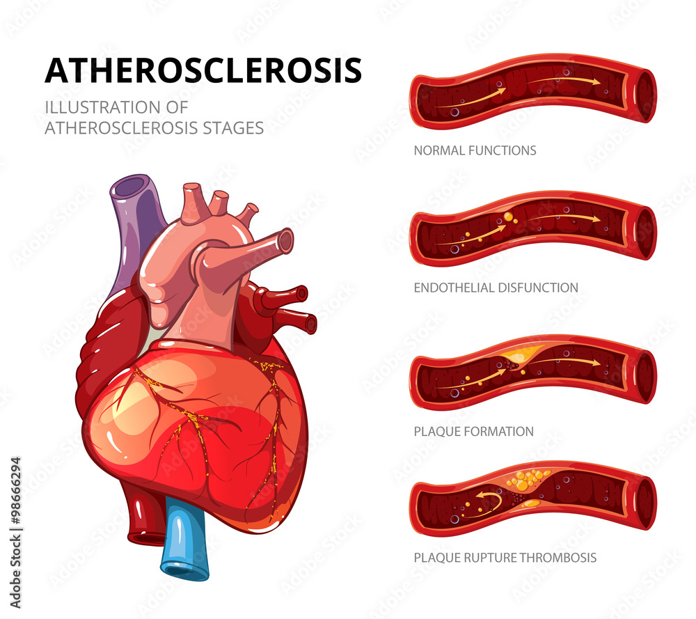 Atherosclerosis. Fibrous plaque formation. Vector infographic Stock ...