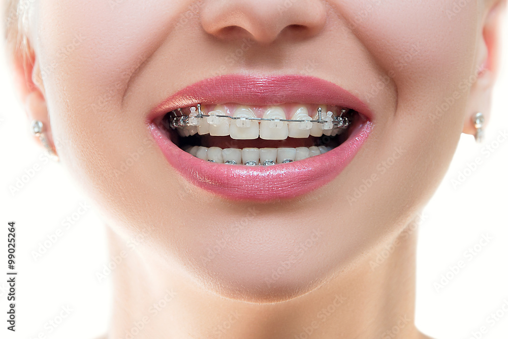 Close up Braces on Teeth. Braces Smile. Orthodontic Treatment. Closeup ...