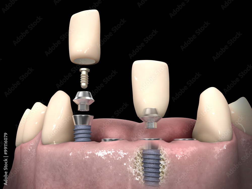 Dental anatomy - Lower incisors with bone structure, teeth, gum section ...