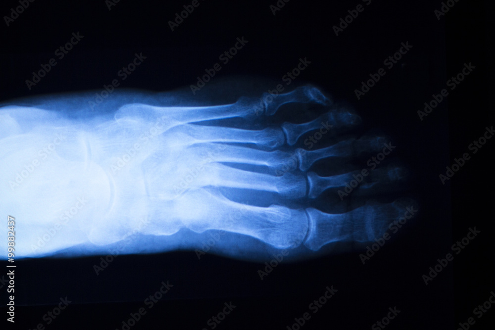 Foot and toes injury x-ray scan Stock Illustration | Adobe Stock