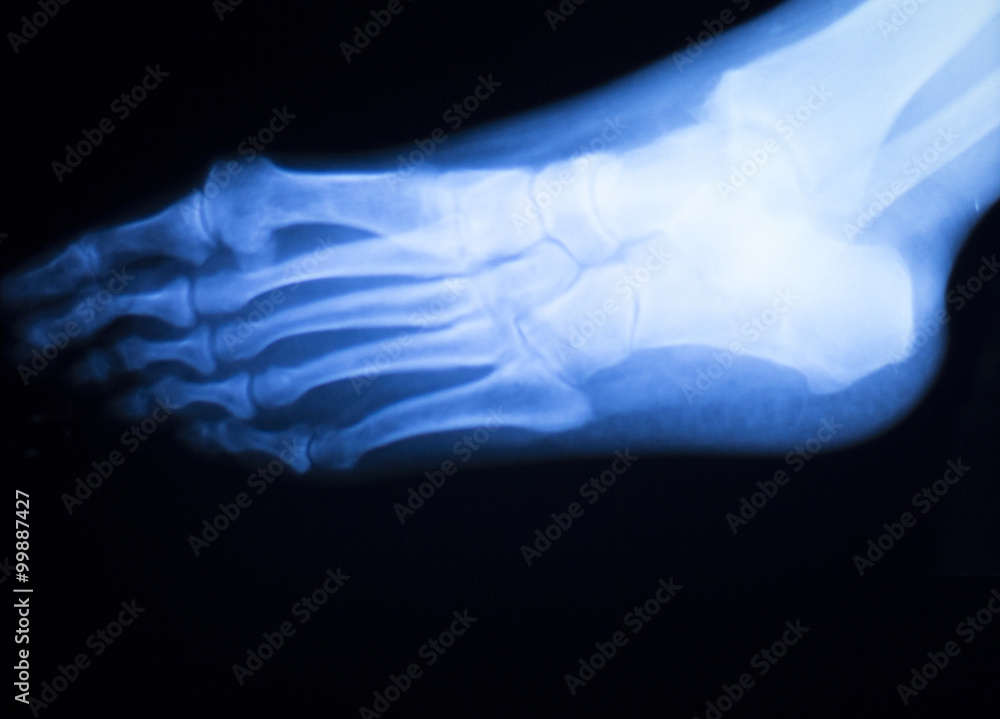 Foot and toes injury x-ray scan Stock Illustration | Adobe Stock