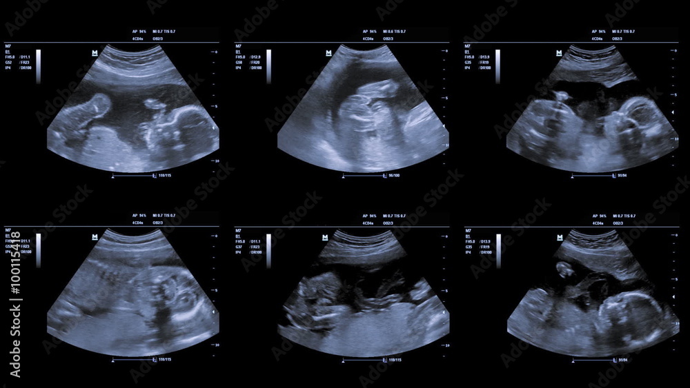 Ultrasound at 22 weeks. Stock Video | Adobe Stock