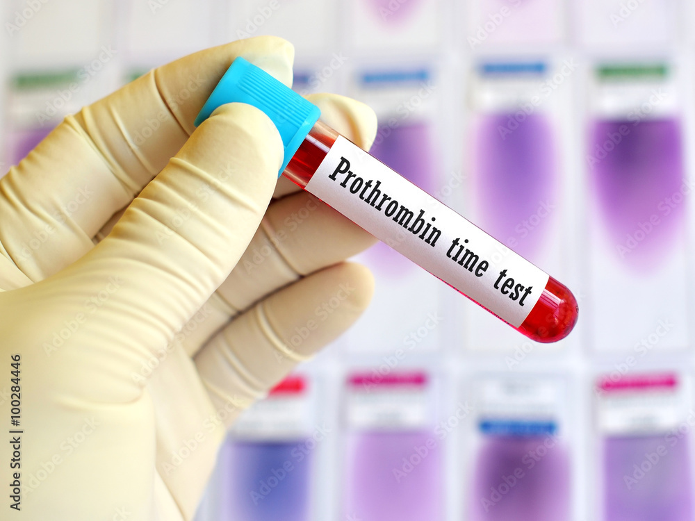 Blood sample for prothrombin time test (Blood coagulation testing ...
