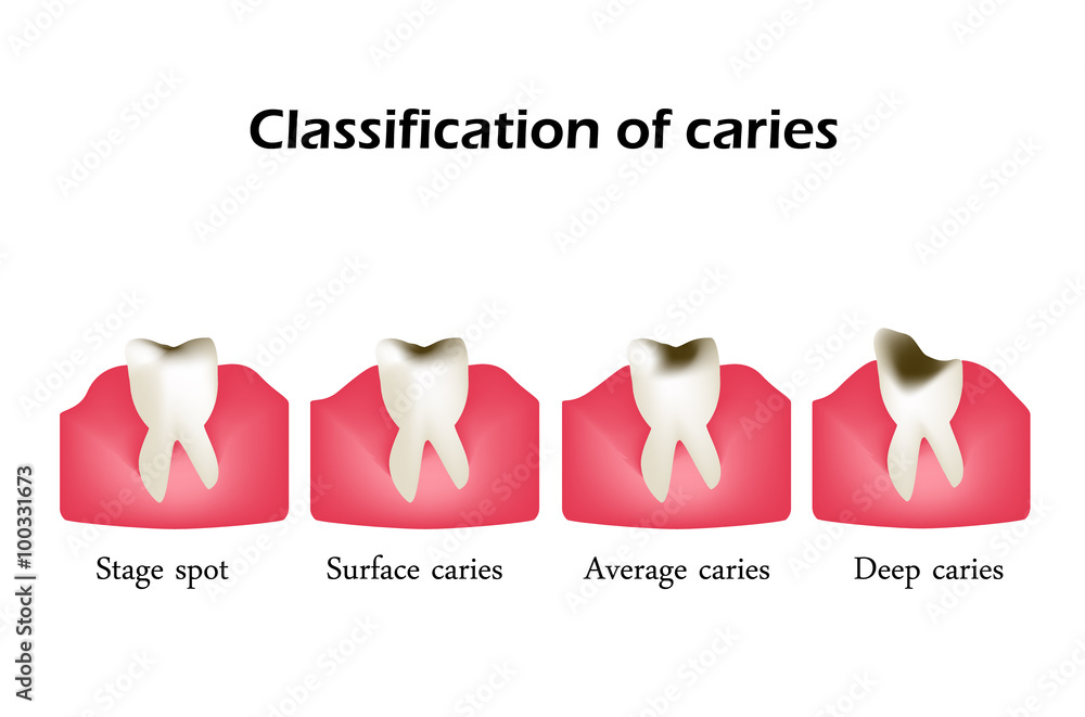 Types of dental caries. Infographics. Vector illustration on isolated ...