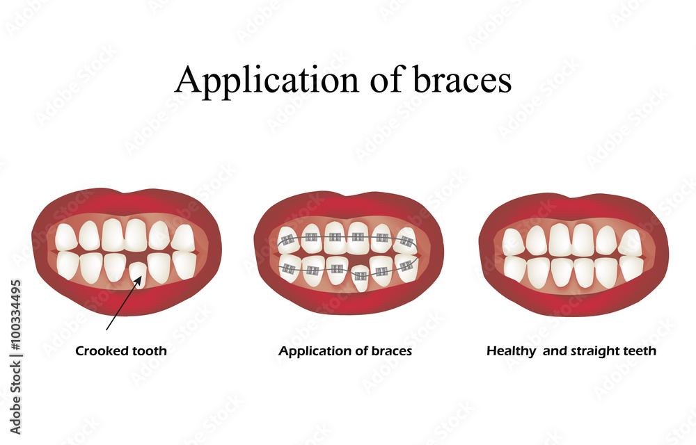 Crooked Teeth Braces