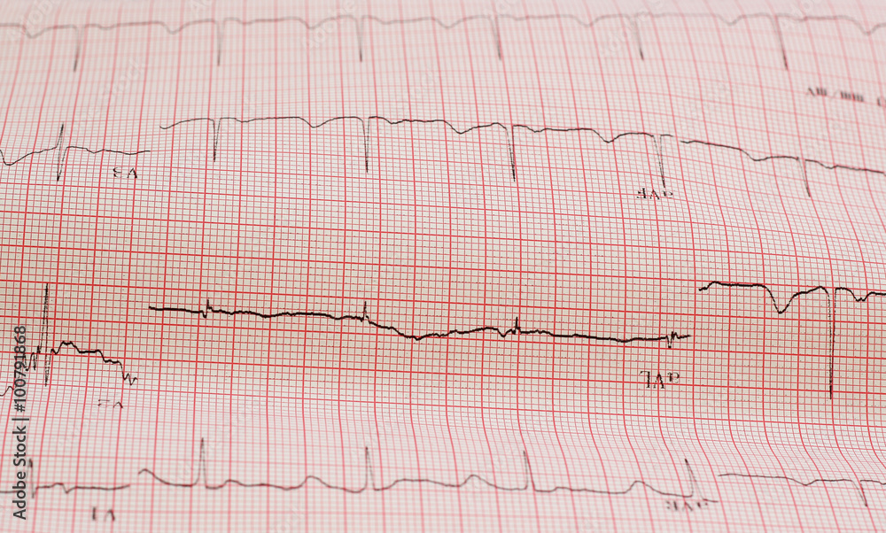 ecg graph, Electrocardiogram ecg Stock Photo | Adobe Stock