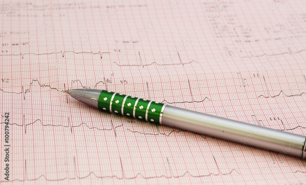 pen and ecg graph, electrocardiogram ekg background Stock Photo | Adobe ...