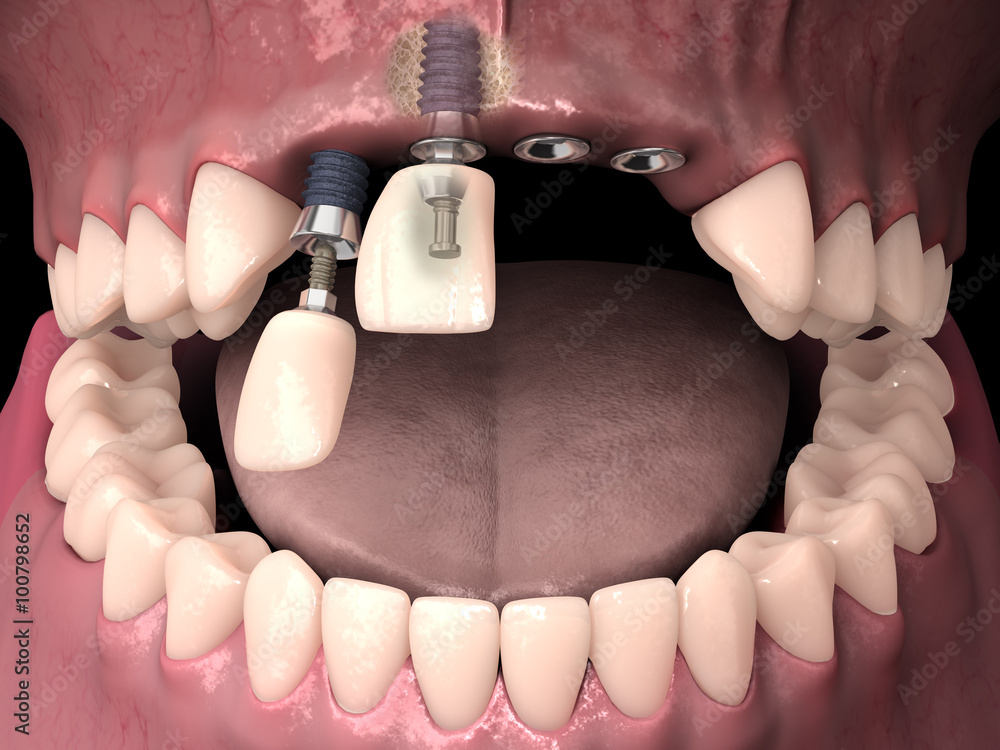 Dental anatomy - Upperr incisors with bone structure, teeth, gum and ...
