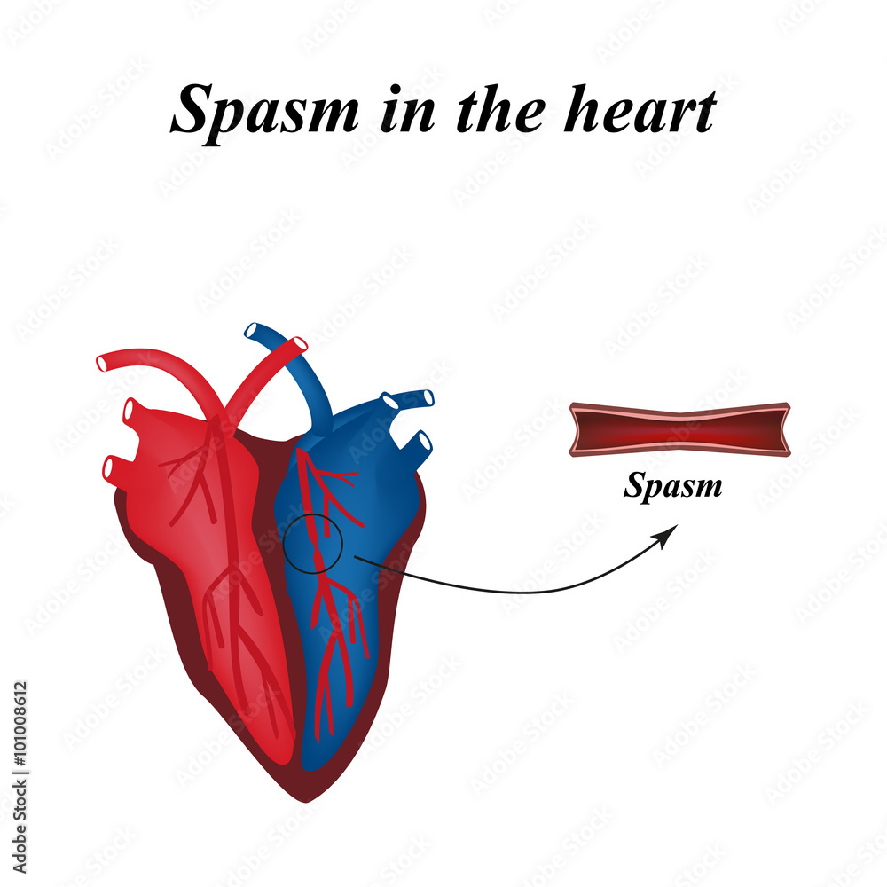 Spasm of the arteries of the heart. Infographics. Vector illustration ...