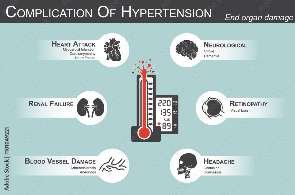 Complication of Hypertension(Heart attack : myocardial infarction ...