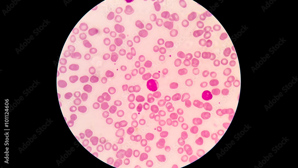 Blast cell - Blood smear under microscope Stock Photo | Adobe Stock