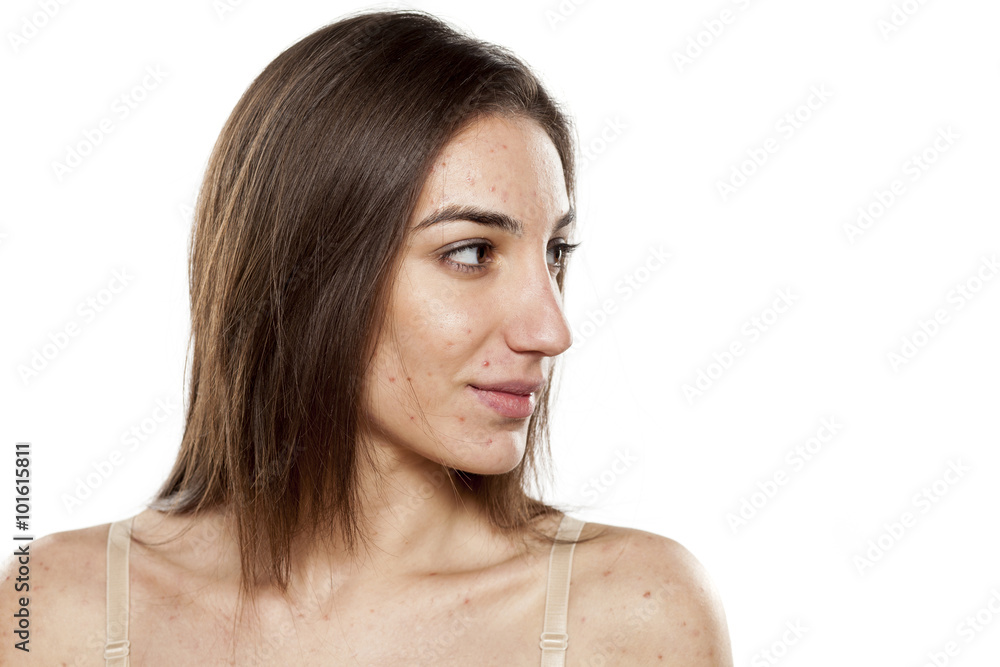 beautiful young women with problematic skin Stock Photo | Adobe Stock