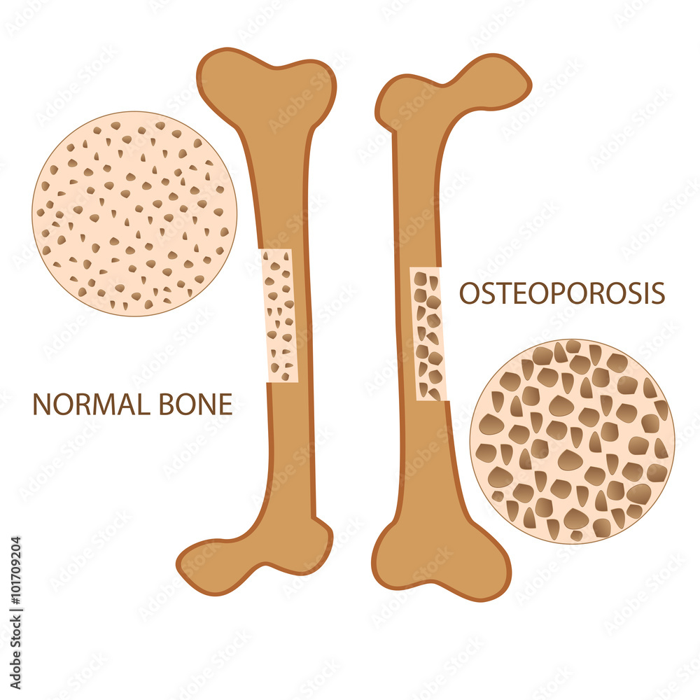 osteoporosis bone anatomy versus normal health bone. vector format ...