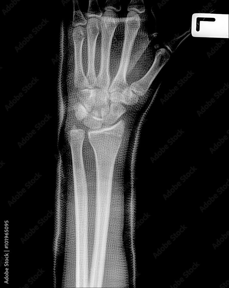 Fracture distal radius (wrist bone) Stock Photo | Adobe Stock